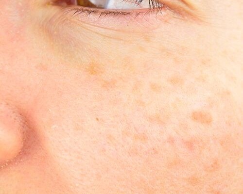 5 Simple Ways To Combat An Uneven Skin Tone | Eminence Organic Skincare