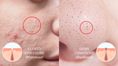 The Best Guide To Congestion….In The Skin! | Eminence Organic Skincare